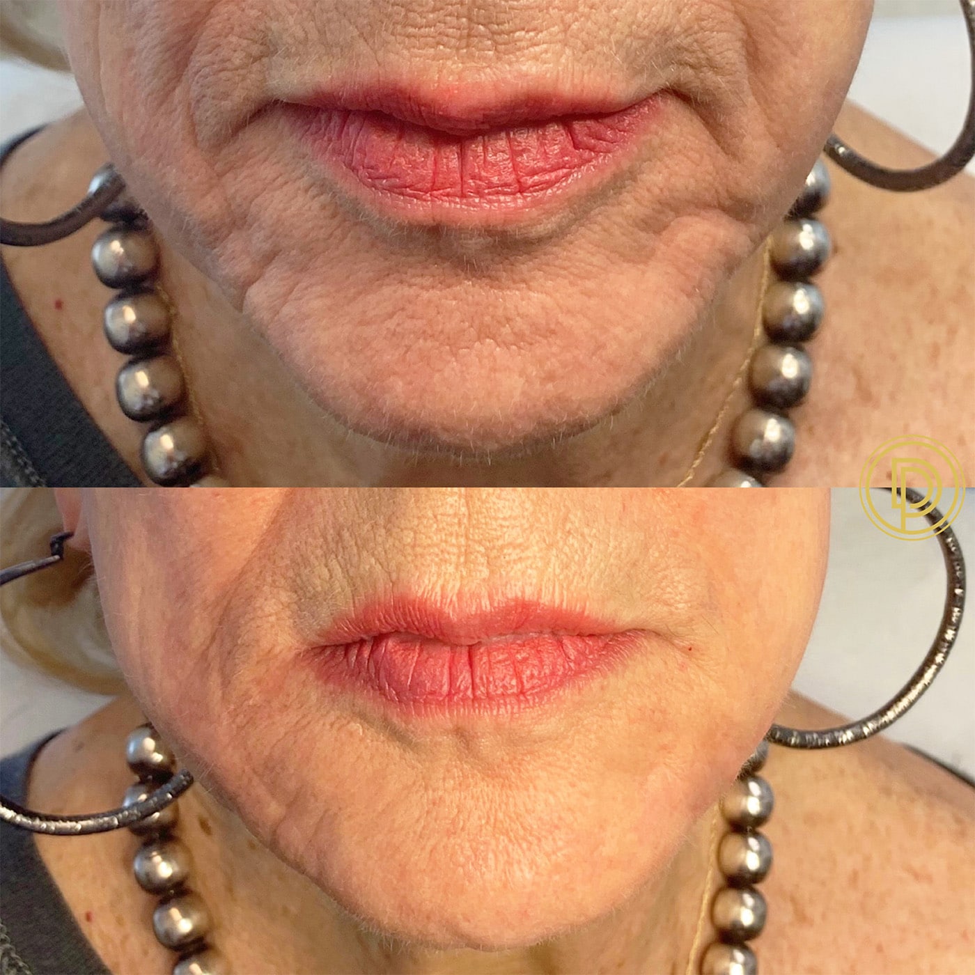 Juvéderm Filler Dallas | Dallas Dermatology Partners