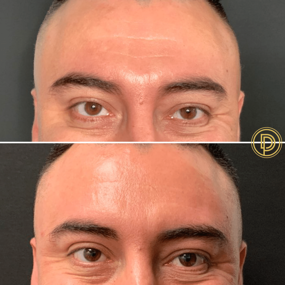 Botox Dallas | Botox Treatment Dallas | Botox Dermatologist Dallas