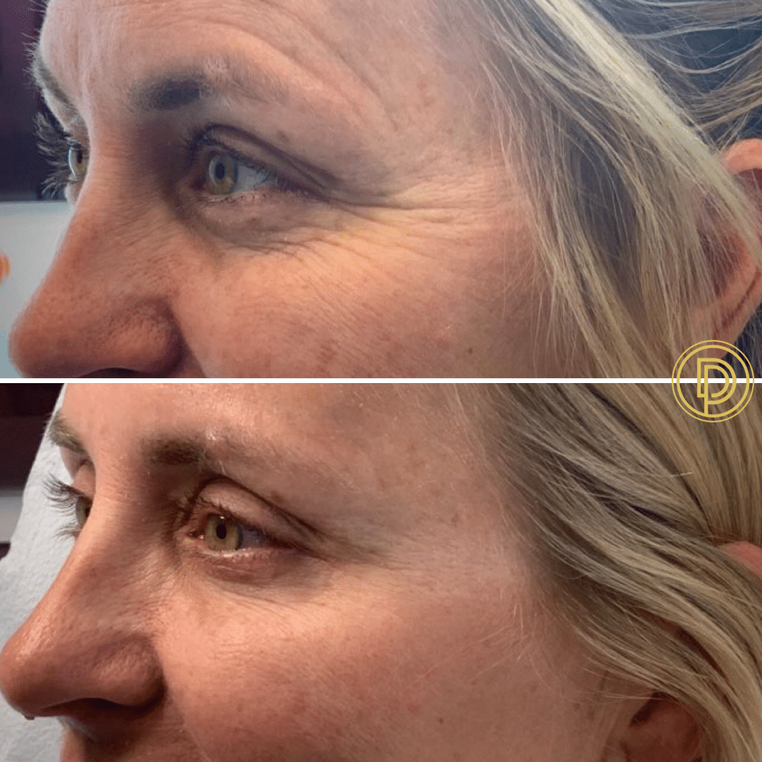 Dysport Dallas | Dysport Treatment | Dallas Dermatology Partners