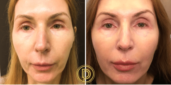 Sculptra Dallas | Sculptra Filler Dallas | Dallas Dermatology Partners