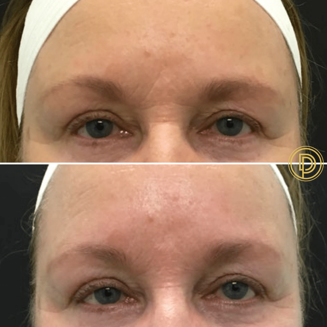 Can You Get Rid of Frown Lines with Botox? | Dallas Dermatology Partners