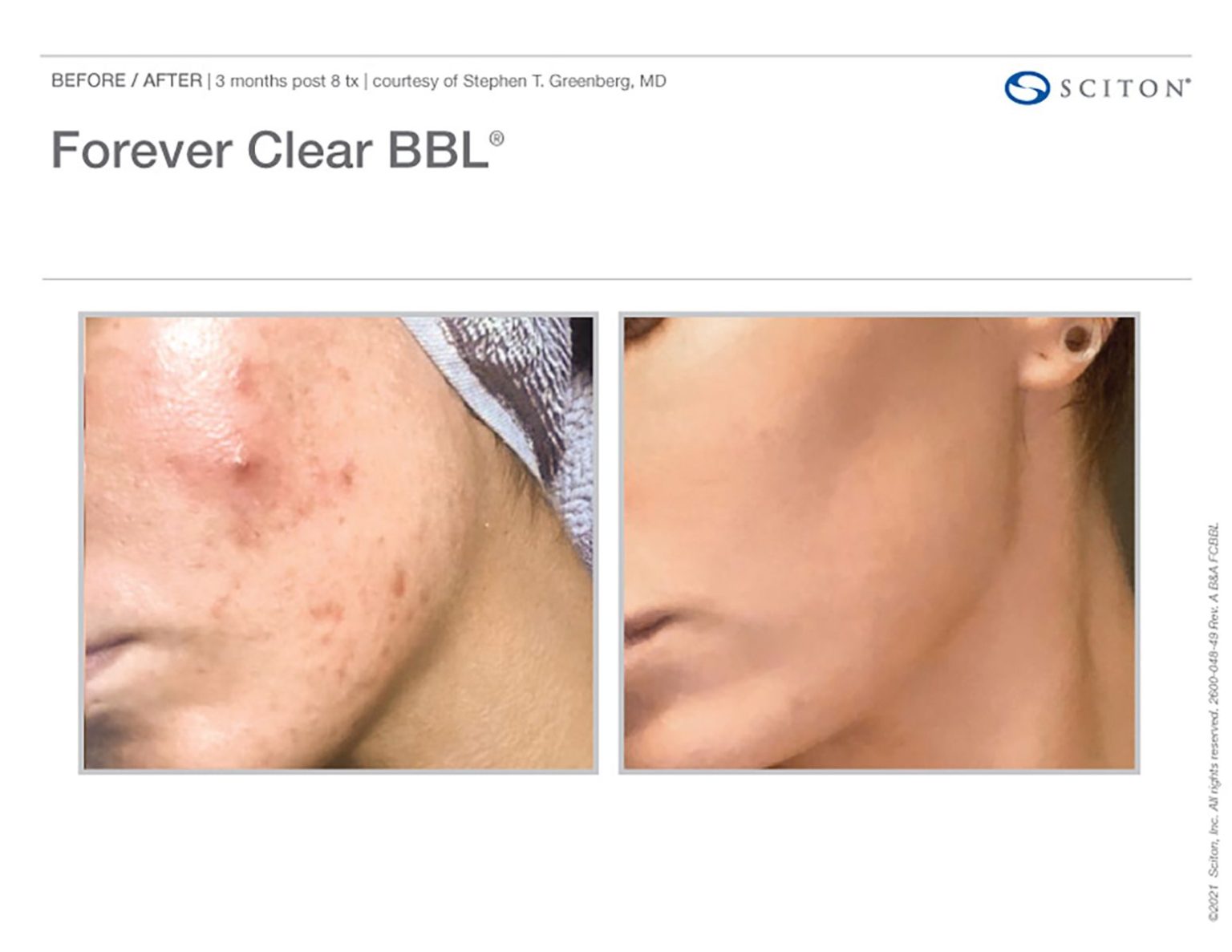 Broadband Light Treatment | Dallas Dermatology Partners