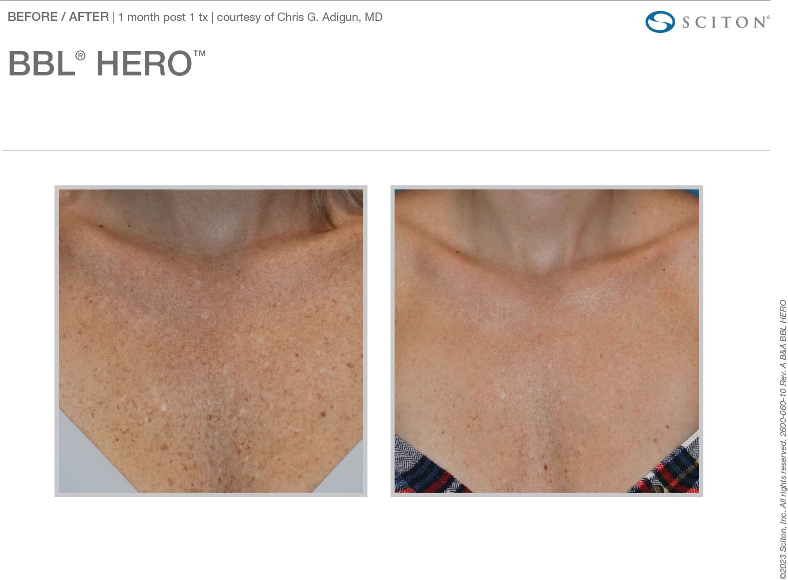 Neck & Chest Rejuvenation with BBL Laser | Dallas Derm Partners