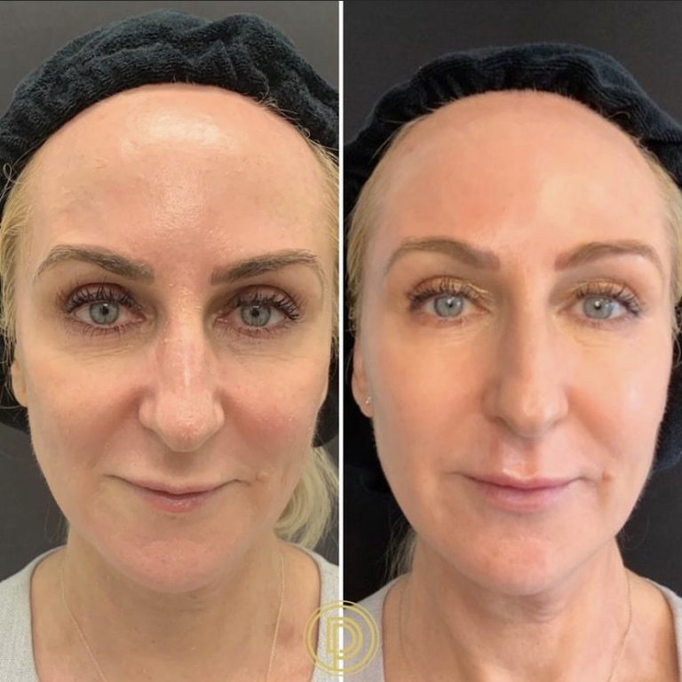 Does Sculptra Work on Nasolabial Folds? | Dallas Derm Partners