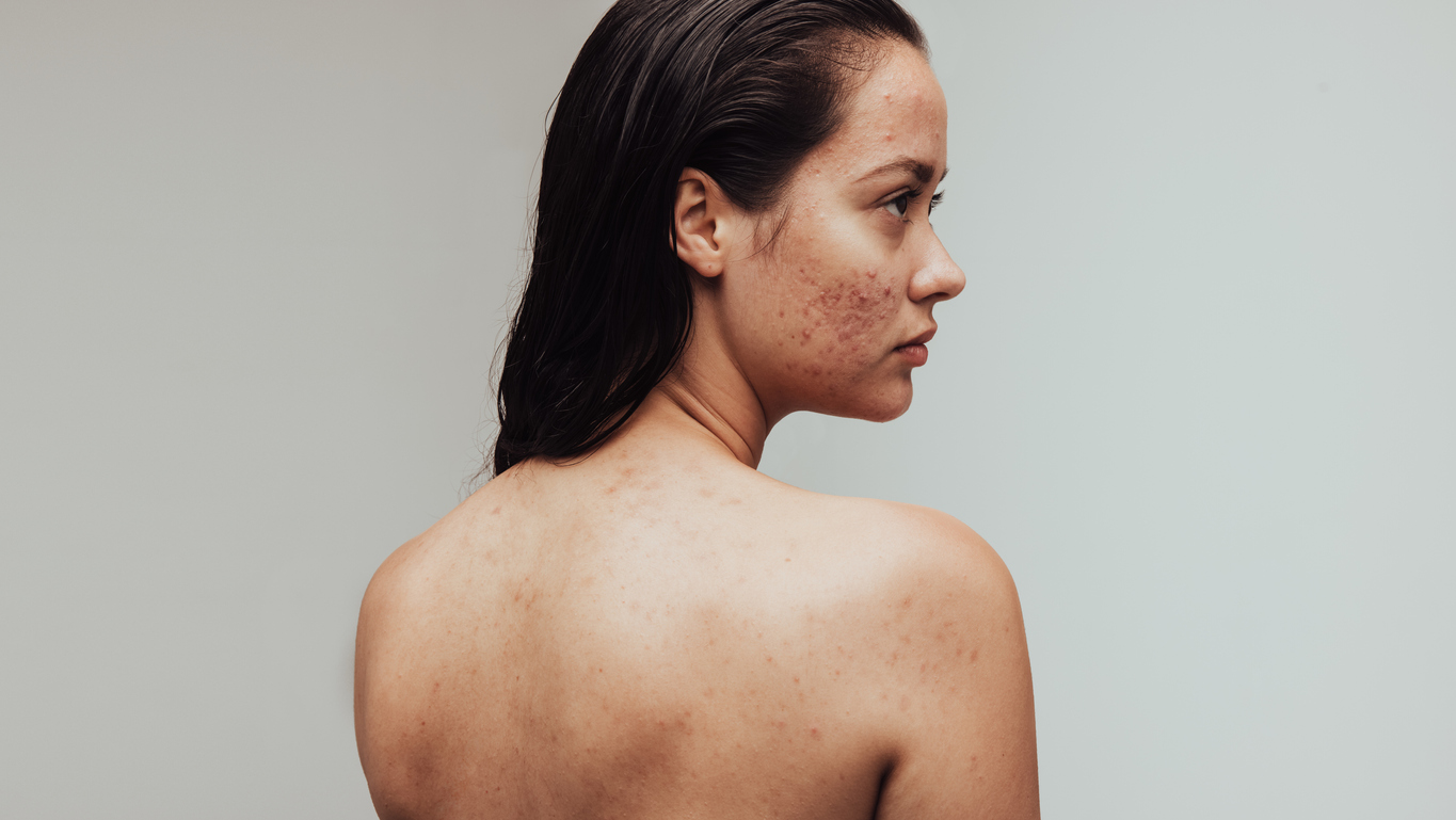 How Do You Treat Severe Acne In Adults Dallas Dermatology Partner