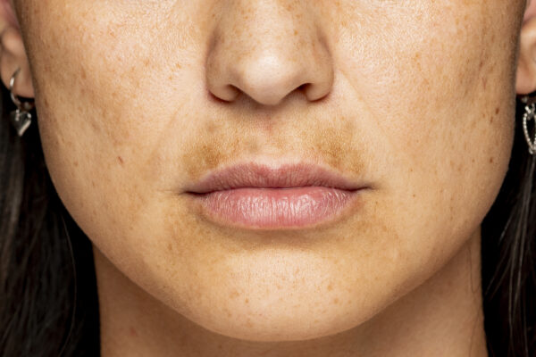 What is A "Sun Mustache" and How to Get Rid of It | Dallas Dermatology ...