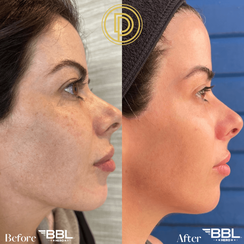Bbl Light Treatment Before And After Shelly Lighting Vrogue co