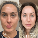 Moxi Laser vs. Halo Laser – Which is Right for You? | Dallas Dermatology Partners