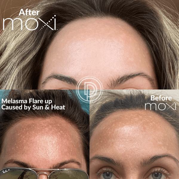 Sciton Moxi Laser Treatment | Dallas Dermatology Partners