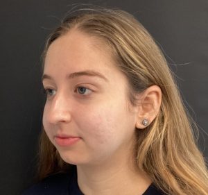 Genius RF Microneedling - Acne | Dallas Derm Partners