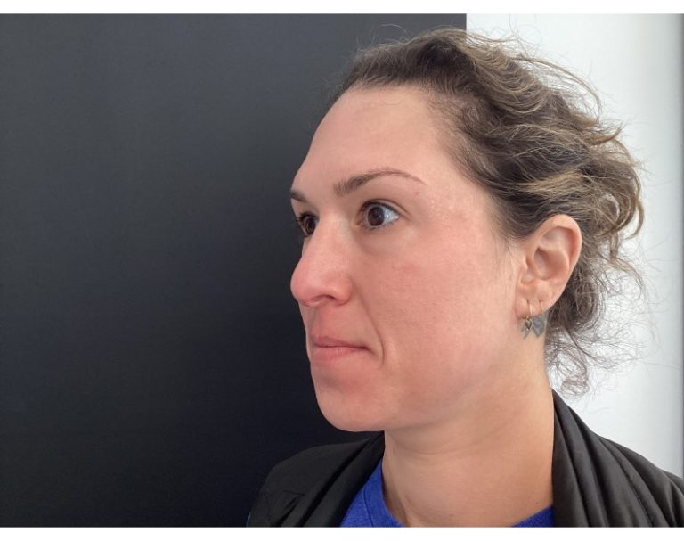 Melanage Face Peel | Dallas Derm Partners