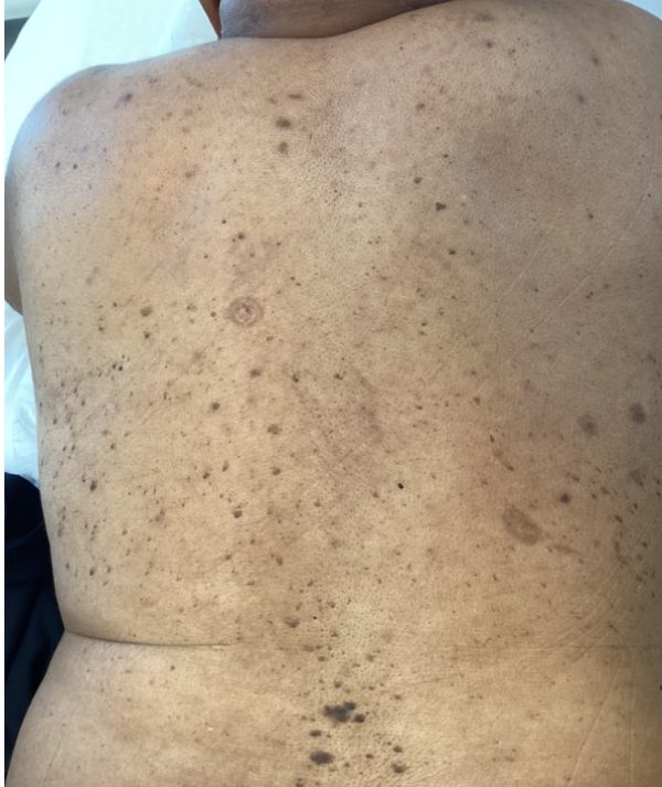 VI Precision Peel - Back | Dallas Derm Partners