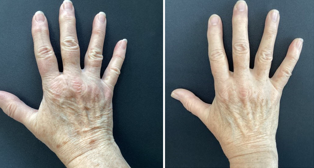 BBL - Broadband Light Laser - Hands | Dallas Derm Partners