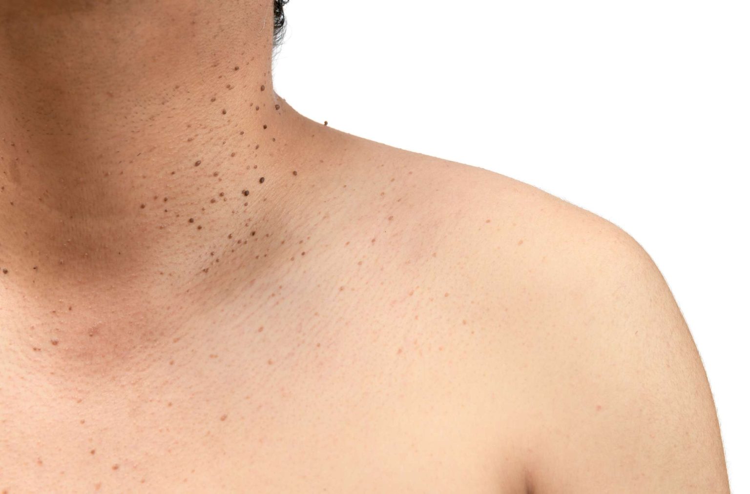 Skin Growth Removal Dallas | Dallas Dermatology Partners